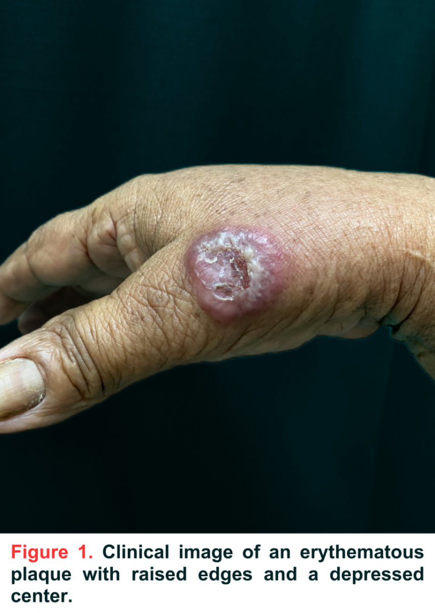Pathergy Phenomenom: Indicator of Recurrent Vegetative Pyoderma Gangrenosum